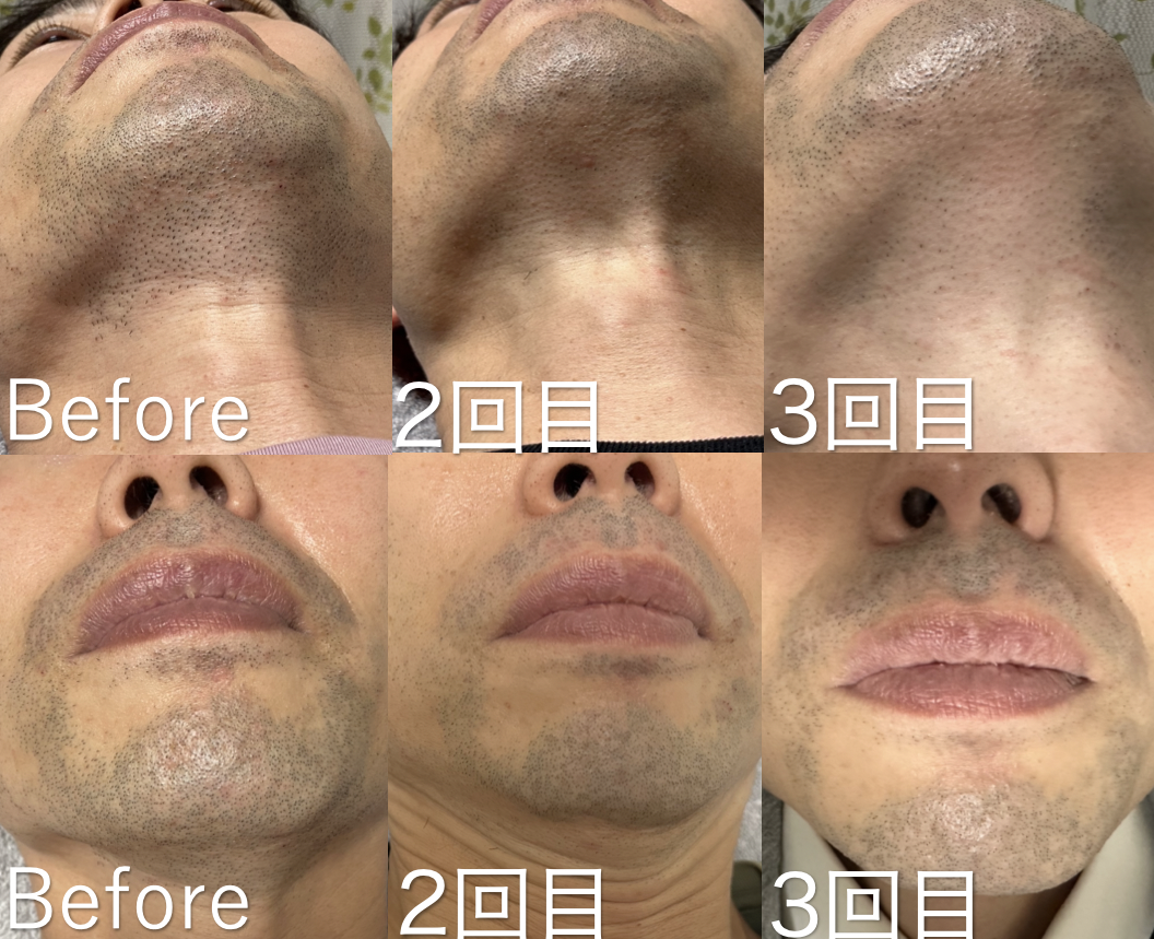 髭(ひげ)脱毛の効果 志木市の脱毛エステサロン【dupont】